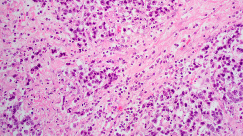 Three types of malignant skin tumors